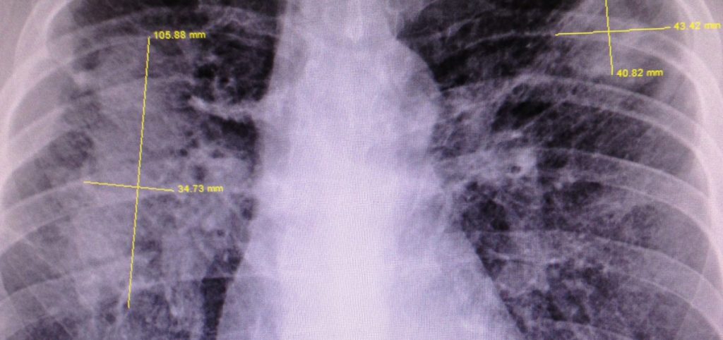 Black Lung Benefits Drop for Kentucky Coal Miners after Controversial ...
